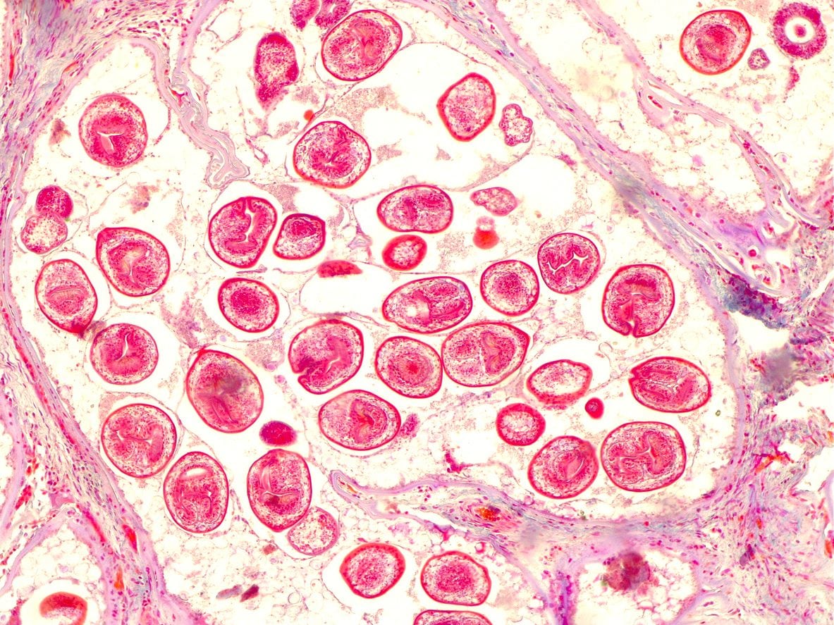 Qu'est-ce que l'infection par le ténia du chien qui a touché un enfant ...